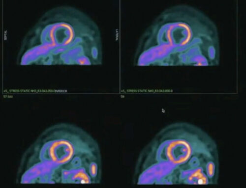 IONETIX Case Study Series - The Value of a Normal Study - Ionetix